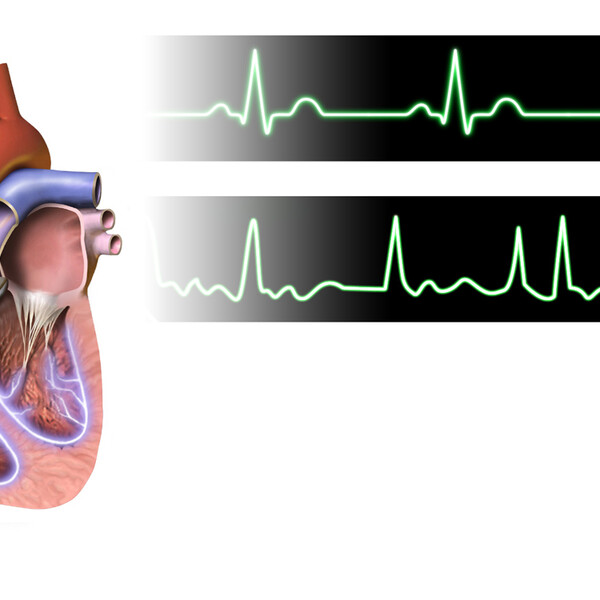 Atrial Fibrillation and Hypertension | Our Bodies Ourselves