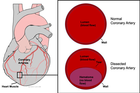 Resources for SCAD: Spontaneous Coronary Artery Dissection | Our Bodies ...